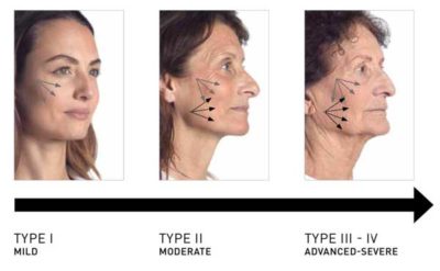 Dermal Fillers London - Zen HealthCare